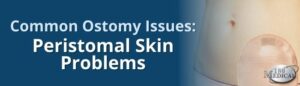 Common Ostomy Issues: Peristomal Skin Problems - 180 Medical